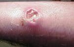 What to Do with an Infected Cut: How to Clean, Disinfect, Treat, and Heal
