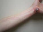 Wound Infection Signs and Symptoms - How to Catch Infections Early